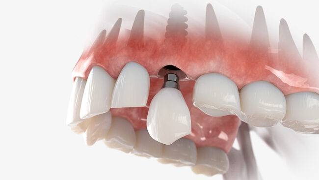 Implants Consult - Stunning Smile Clinic | Dentist in West Ealing